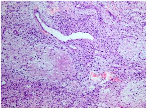 Stroma Ovary Pathology