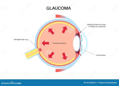 Glaucoma Eye Pressure Stock Vector Illustration Of Sight 331365016