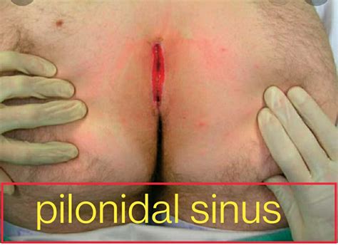 Pilonidal Sinus Treatment In Ghaziabad Dr Hemendra Singh