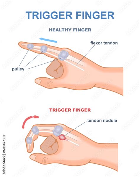 Trigger Finger Diagram Joints Stuck In Bent Position Anatomy Of