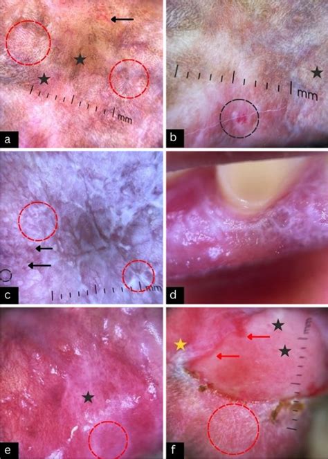 Oral Lichen Planus Mucoscopic Perspective Journal Of Skin And Sexually Transmitted Diseases