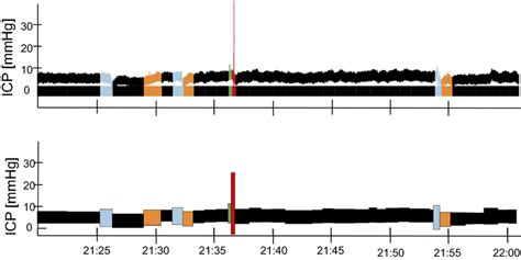 Example Of The Icp Signal Segmentation And Classification Into Labels
