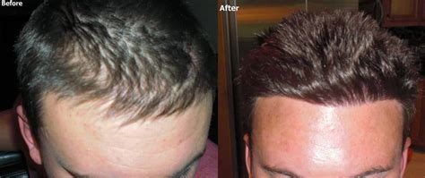 Frontal Thinning Hair Restoration Result Alvi Armani International