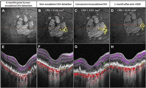 Detection Of Nonexudative Choroidal Neovascularization And Progression