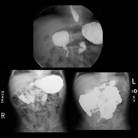 Infant With Bilious Vomiting Pediatric Radiology Case Pediatric