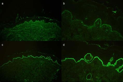 Direct Immunofluorescence A Mixed Linear And Granular Deposition Of