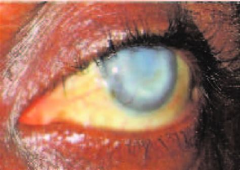 Sclerosing Keratitis Download Scientific Diagram