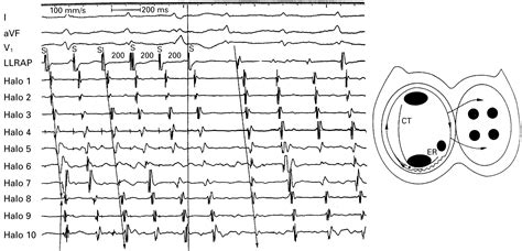 Electrophysiological Determinant For Induction Of Isthmus Dependent Counterclockwise And