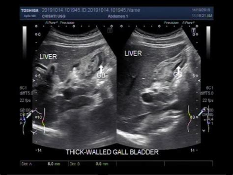 Worried About A Thick Gallbladder Wall Here Is Whats Next Answer