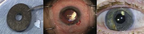 Results In Combined Cataract Surgery With Prosthetic Iris Implantation