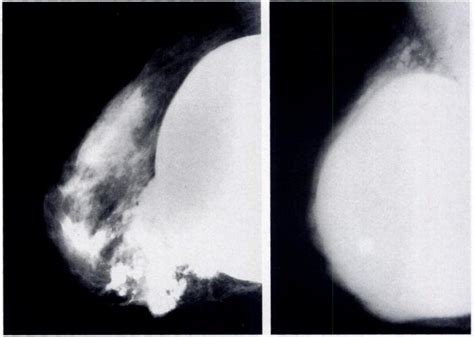 Do I Need A Breast Implants Replacement How Often Mcan Health Blog