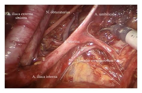 Left Vascular Mesometrium Mm With Exposed Uterine Vessels Download Scientific Diagram
