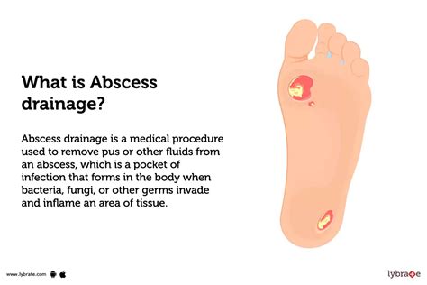 Abscess Drainage Causes Symptoms Treatment And Cost