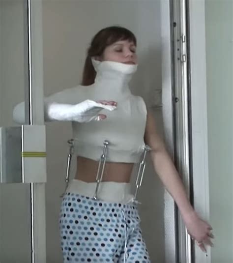 Emily In Rissers Stagnara Body Plaster Cast With Shoulder Spica Cnews
