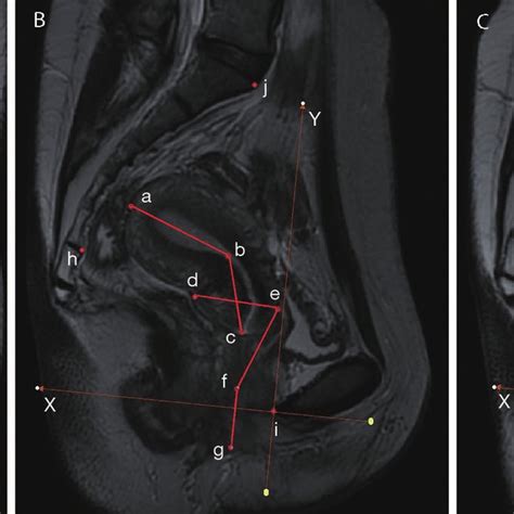 Uterus And Vagina Analysis A The Central Sagittal Mri Of One Subject