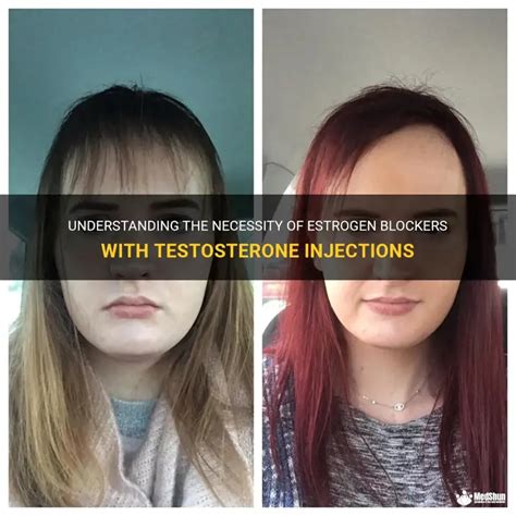 Understanding The Necessity Of Estrogen Blockers With Testosterone Injections Medshun