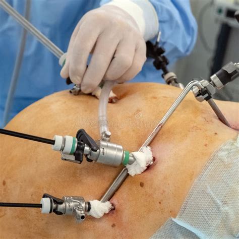 Endoscopia Laparoscopia Las Manos De Doctores Usando Los Instrumentos