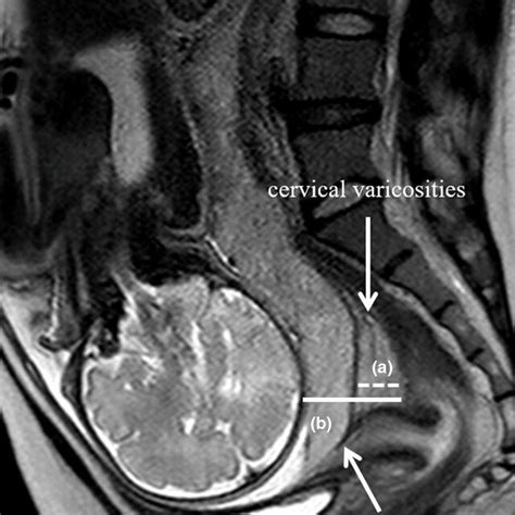 Assessment Of Cervical Varicosities Using Magnetic Resonance Imaging In