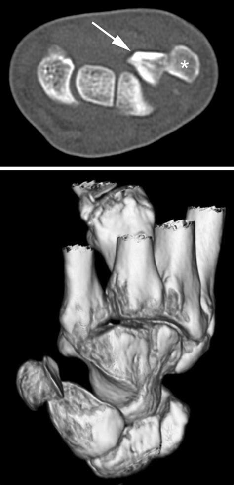 Volar Dislocation Of The Triquetrum Case Report And Review Of Literature Abstract Europe Pmc