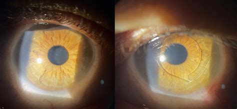 Aciol Anterior Chamber Iol Piece