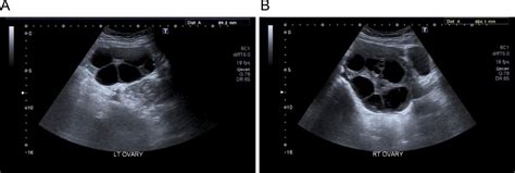 Placental Mesenchymal Dysplasia Associated With Spontaneous Ovarian