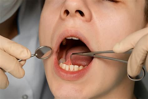 Comprehensive Guide To Frenectomy Procedure Types Cost And Faqs