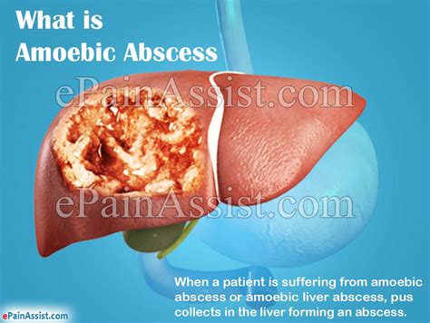 What Is Amoebic Abscess Or Amoebic Liver Abscesscausessymptoms