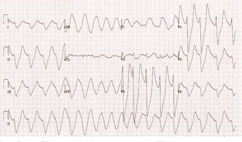 Sine Wave Ecg