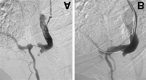 A Left Carotid Angiogram Lateral View Showing No Abnormal