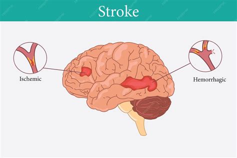 Premium Vector Human Anatomy Disease Stroke Vector Illustration On