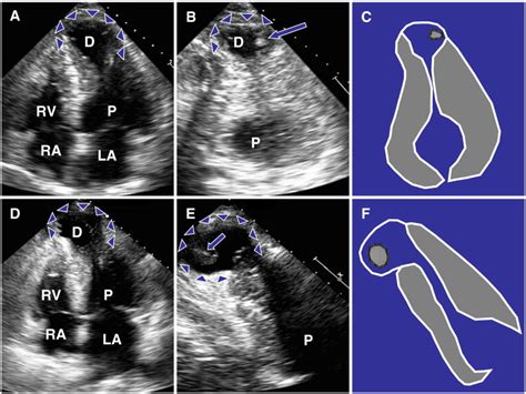 Hypertrophic Cardiomyopathy With Left Ventricular Apical Aneurysm In