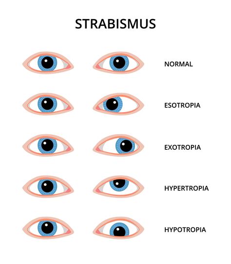 Going Cross Eyed Discover The Facts About Adult Strabismus