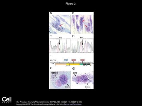 First Reported Patient With Human Ercc1 Deficiency Has Cerebro Oculo