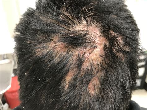 Dissecting Cellulitis Stock Image C0602979 Science Photo Library