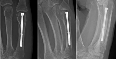 Aahs Clinical Outcomes Of Limited Open Retrograde Intramedullary