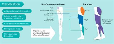 Intermittent Claudication Ic Due To Peripheral Arterial Disease