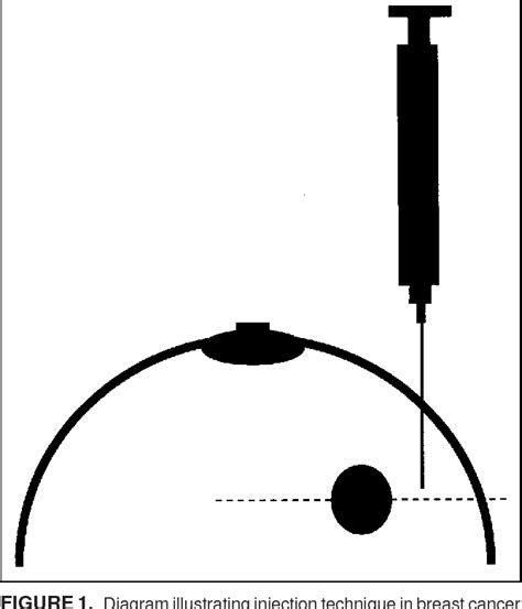 Figure 1 From Technical Aspects Of Sentinel Node Lymphoscintigraphy For