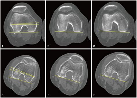 Accuracy Of 2d Ct Based Measurements Of Rotational Alignment Of The