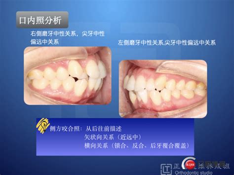 我的2023年之腭侧种植支抗联合tpa绝对支抗解除重度拥挤 毛玲mao的博客 Kq88口腔博客