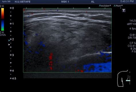 292 Fibroelastoma Dorsi Ecografía Fácil