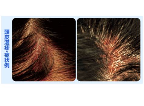 头皮湿疹的图片头皮湿疹的症状图片头皮湿疹文秘苑图库