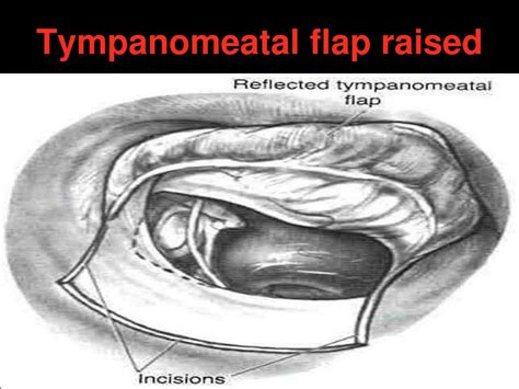 Ppt Otosclerosis Powerpoint Presentation Free Download Id5301220