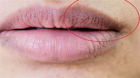 How To Get Rid Of Hyperpigmentation On Lips At Roderick Wilkerson Blog How To Get Rid Of Hyperpigmentation On Lips At Roderick Wilkerson Blog