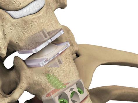 Posterior Cervical Fixation Lateral Mass Rajkamal Neuro