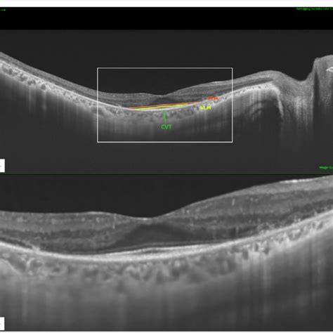 Ss Oct Image Of The Right Eye A Annotated Scan B Magnified