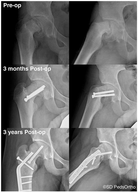 Prospective Evaluation Of In Situ Screw Fixation For Stable Slipped