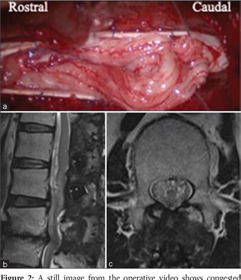 Figure 2 From Redundant Nerve Root Syndrome Mimicking An Intradural
