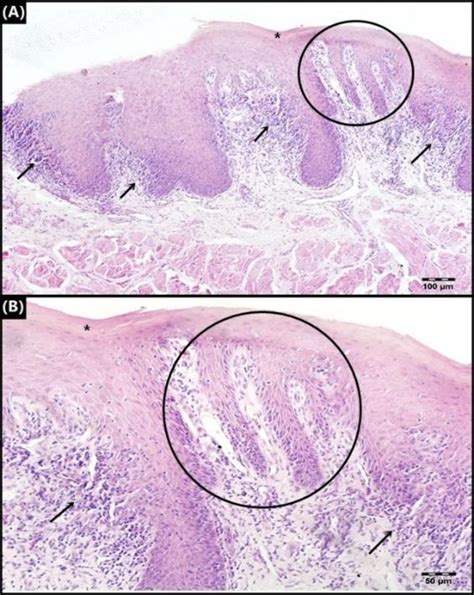 He Photomicrographs Showing Hyperparakeratosis Areas Of Atrophic