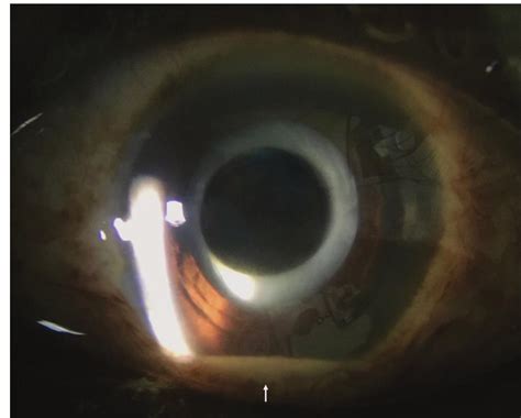 Hypopyon White Arrow In The Anterior Chamber In A Patient