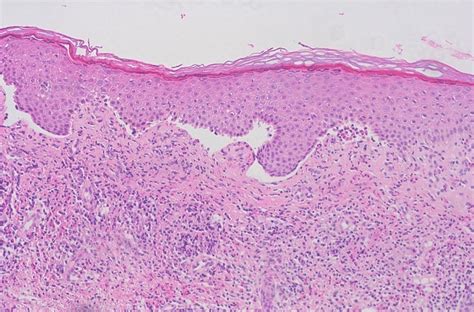 A Subepithelial Vesicles With Dermal Infiltration Of Lymphocytes